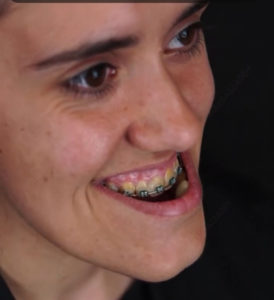 Jaw surgery completely changed this girl’s life… Just look at the ...