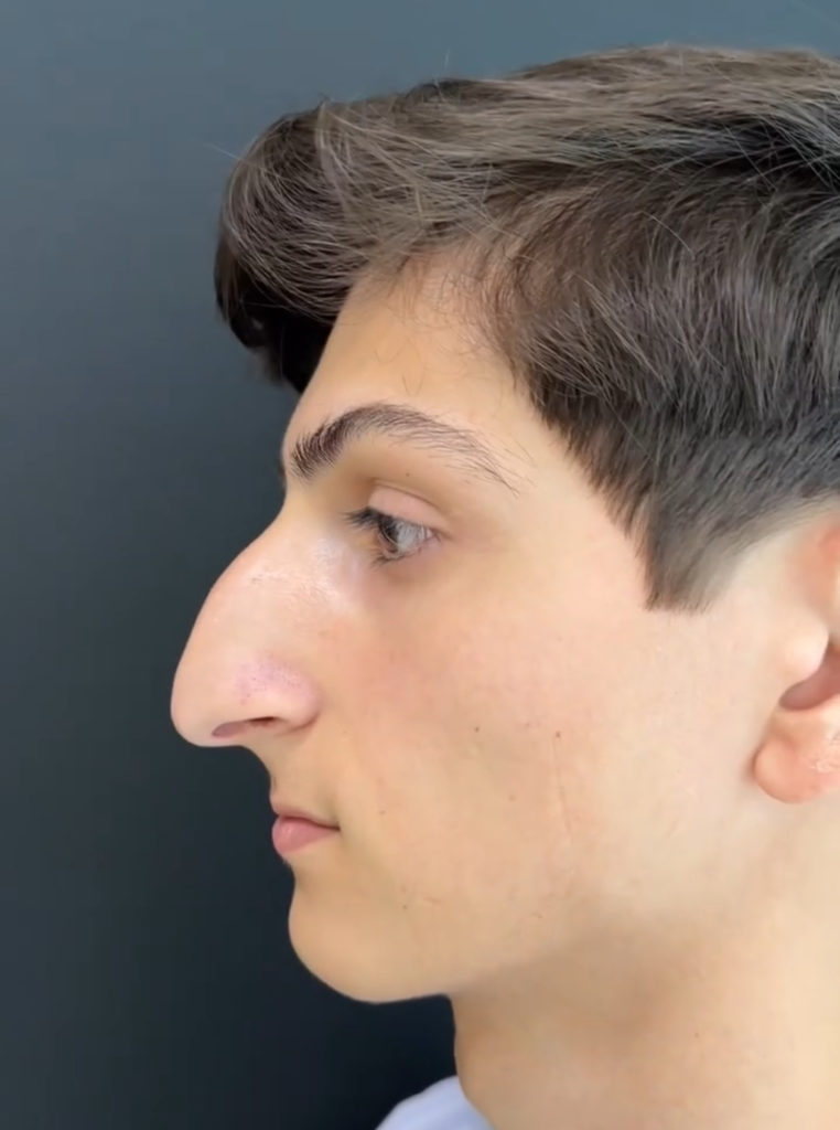 This guy became unrecognizable after his nose surgery… You won’t ...